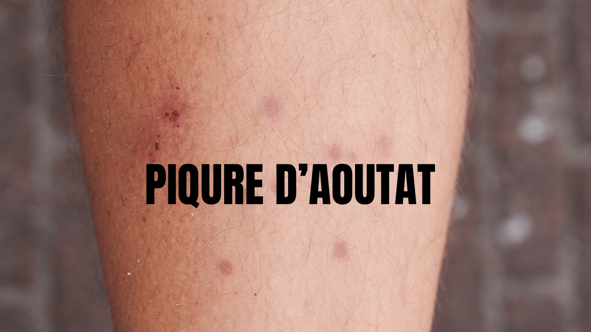 Comment traiter et prévenir les piqûres d'aoutat?