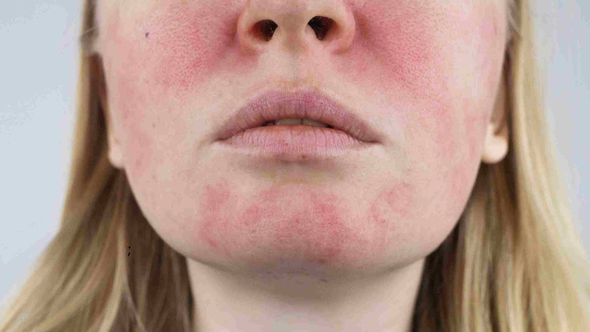 La rougeur au visage: Comment la combattre?
