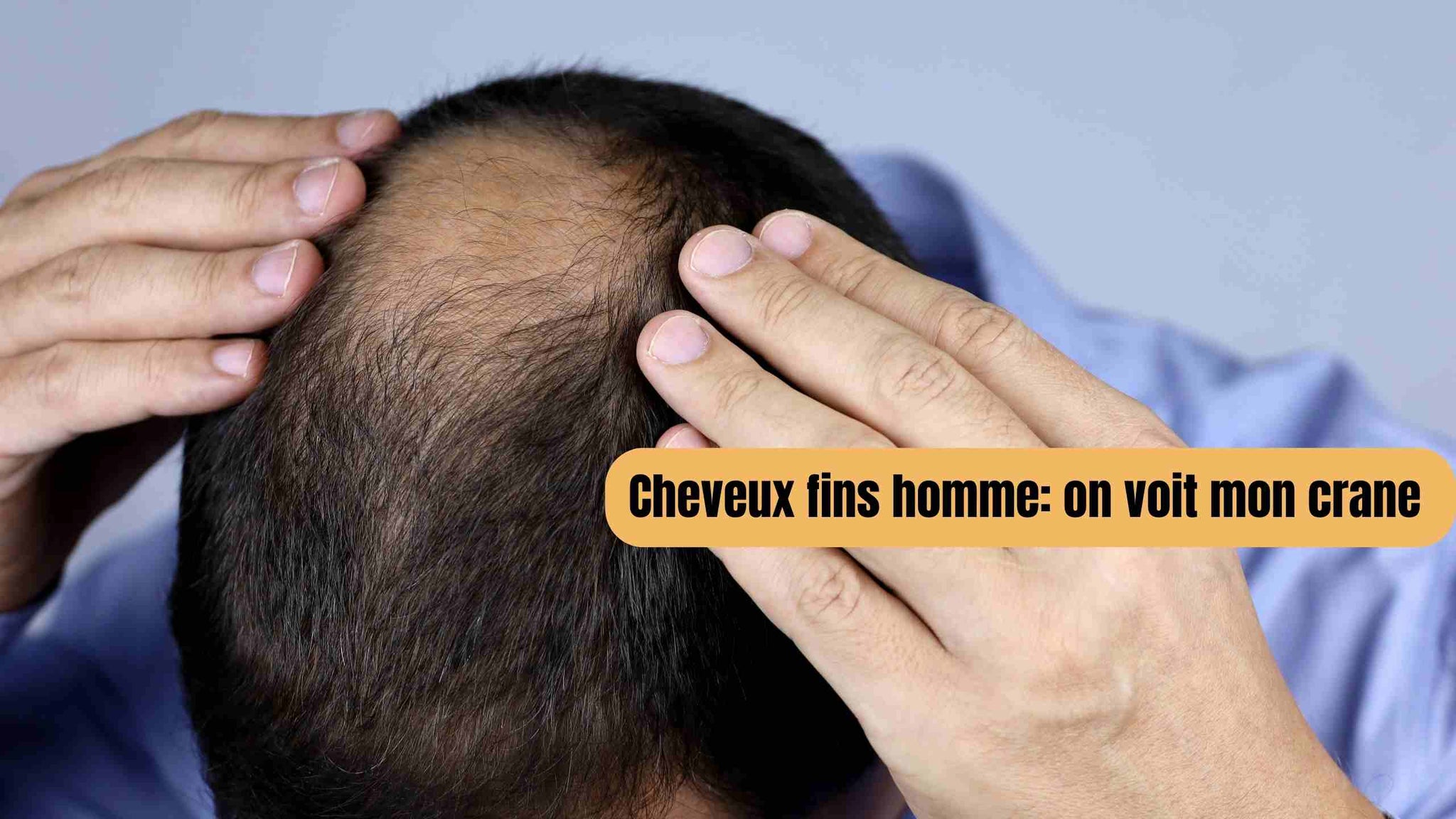 Cheveux fins homme : Pourquoi on voit mon crâne?
