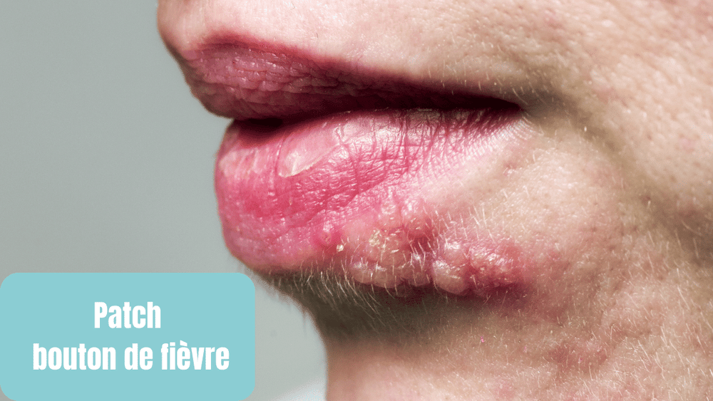 Patchs pour boutons de fièvre : Votre solution discrète et efficace