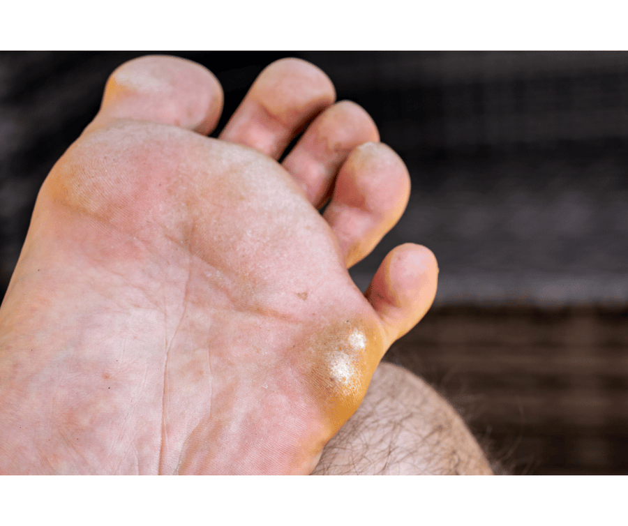 Comment soigner un cor au pied grâce aux remèdes de grand-mère?