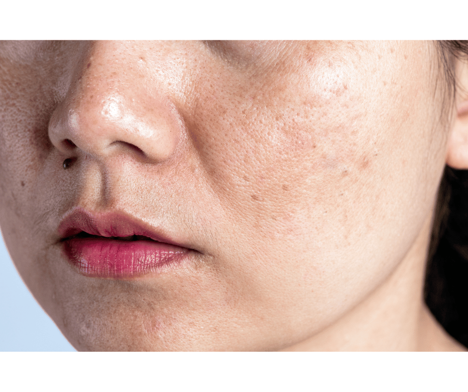 Qu'est-ce qu'un trou dans la peau ? Causes, symptômes et traitement